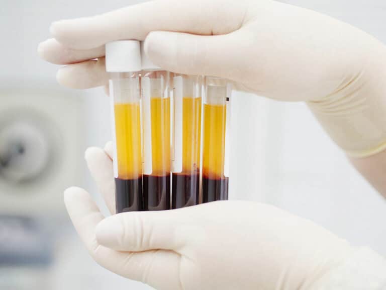 PRP: 4 categorías de concentrado plaquetario - Cursos Ginecoestética